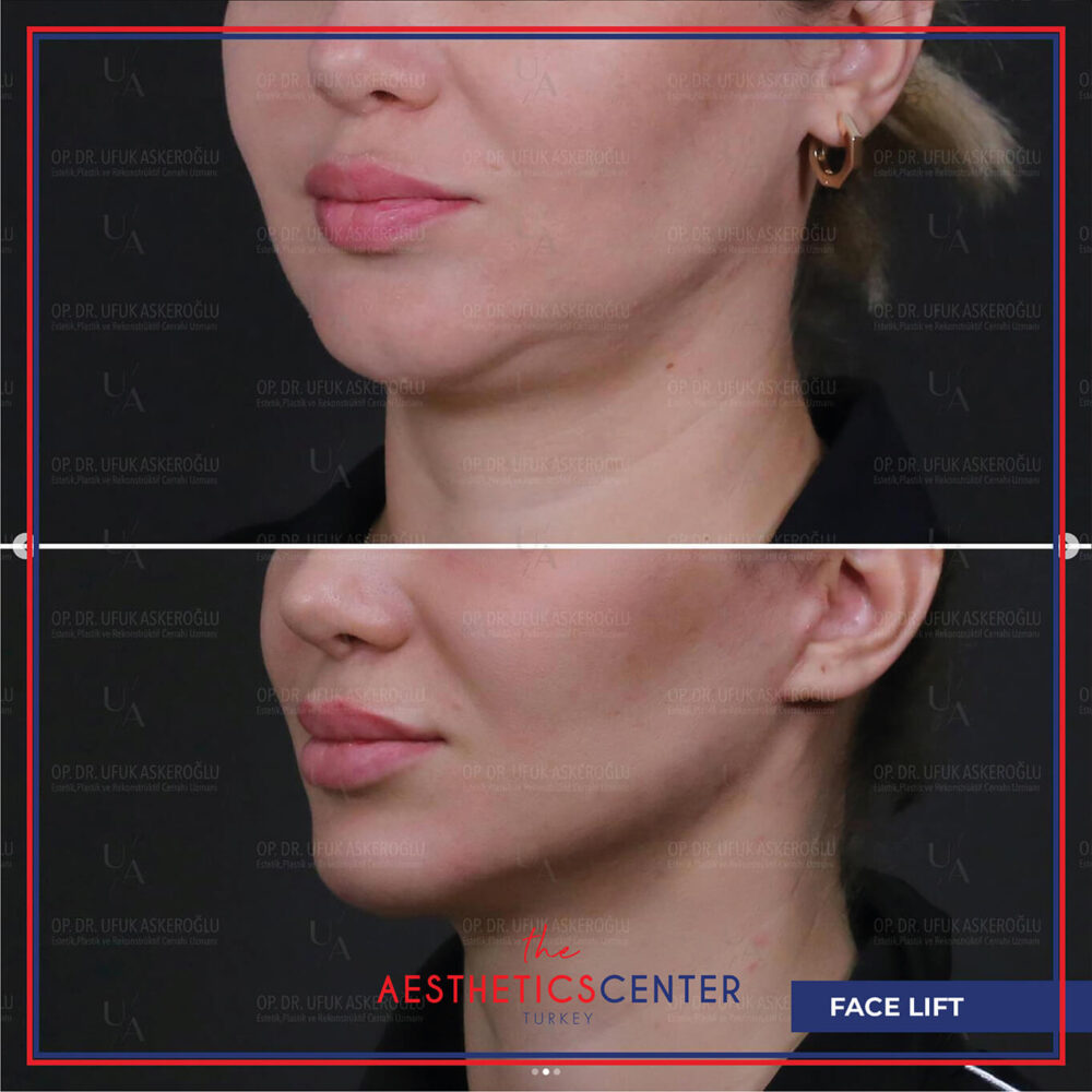 Deep Plane Facelift - Aesthetic Center Turkey