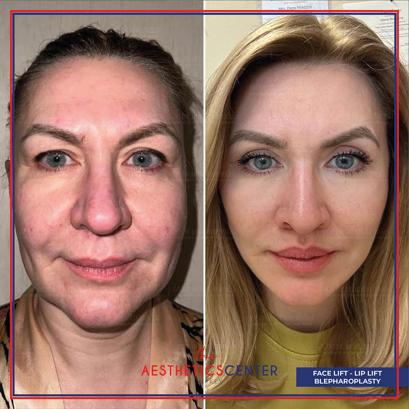 Deep Plane Facelift - Aesthetic Center Turkey