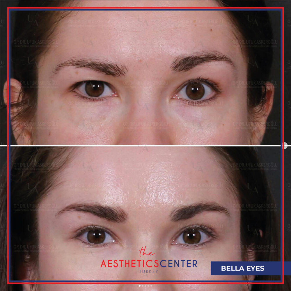 Bella Eyes - Aesthetic Center Turkey